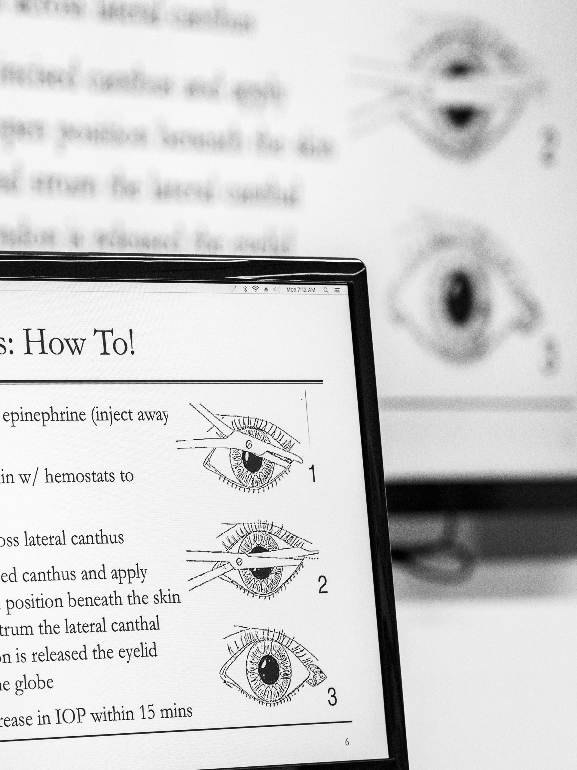 Canthotomy/Cantholysis & Lid Laceration Repair - Wills Eye Library